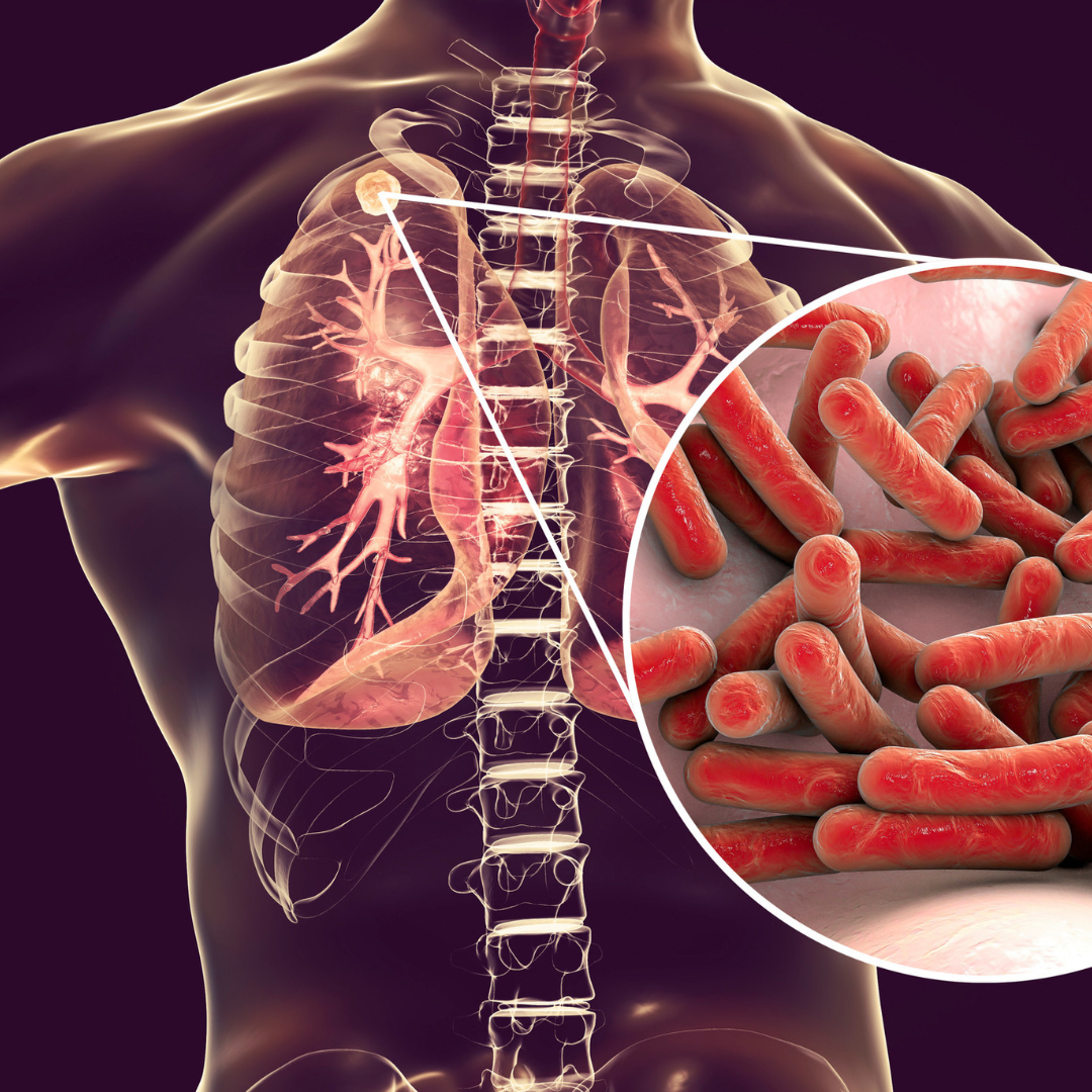 Tuberculosis - Lancet Laboratory